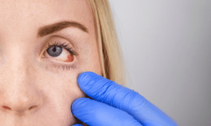 Uveitis Symptoms, Causes, and Treatments | Youth Vision